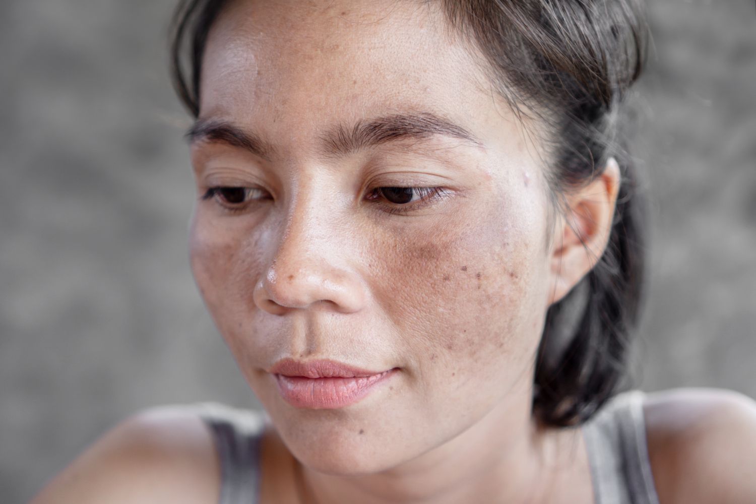 Melasma in Pregnancy: Causes, Symptoms, Prevention - Small children